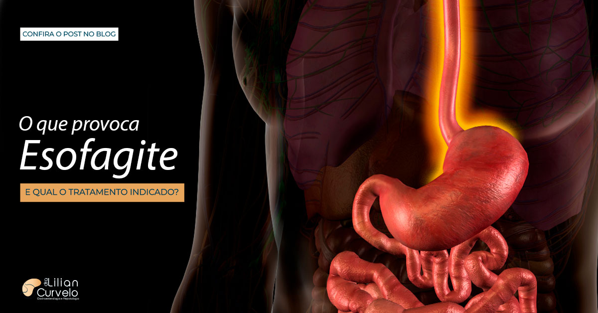 O que provoca esofagite e qual o tratamento indicado ...